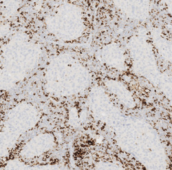 Breast Cancer Assay - Roche Diagnostics - MLM Magazine - MedicalLab ...